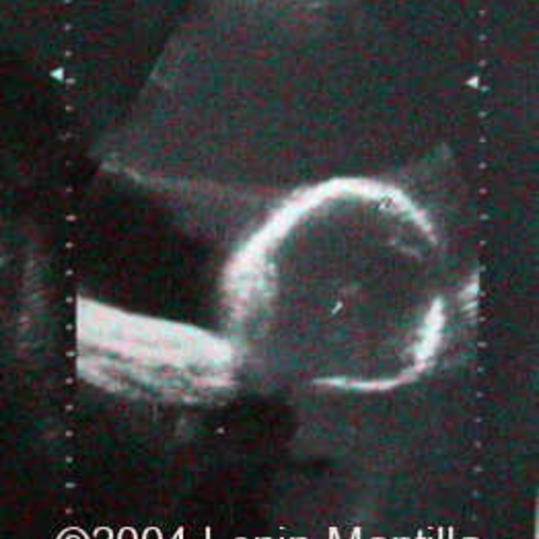 📃 Alobar holoprosencephaly, ethmocephaly