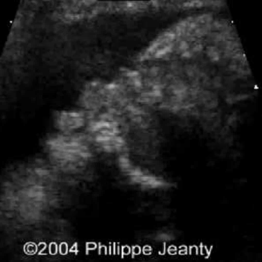 📃 Macroglossia, video clip