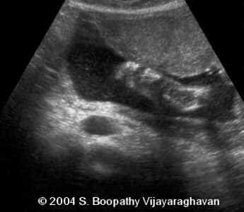 📃 Congenital icthyosis