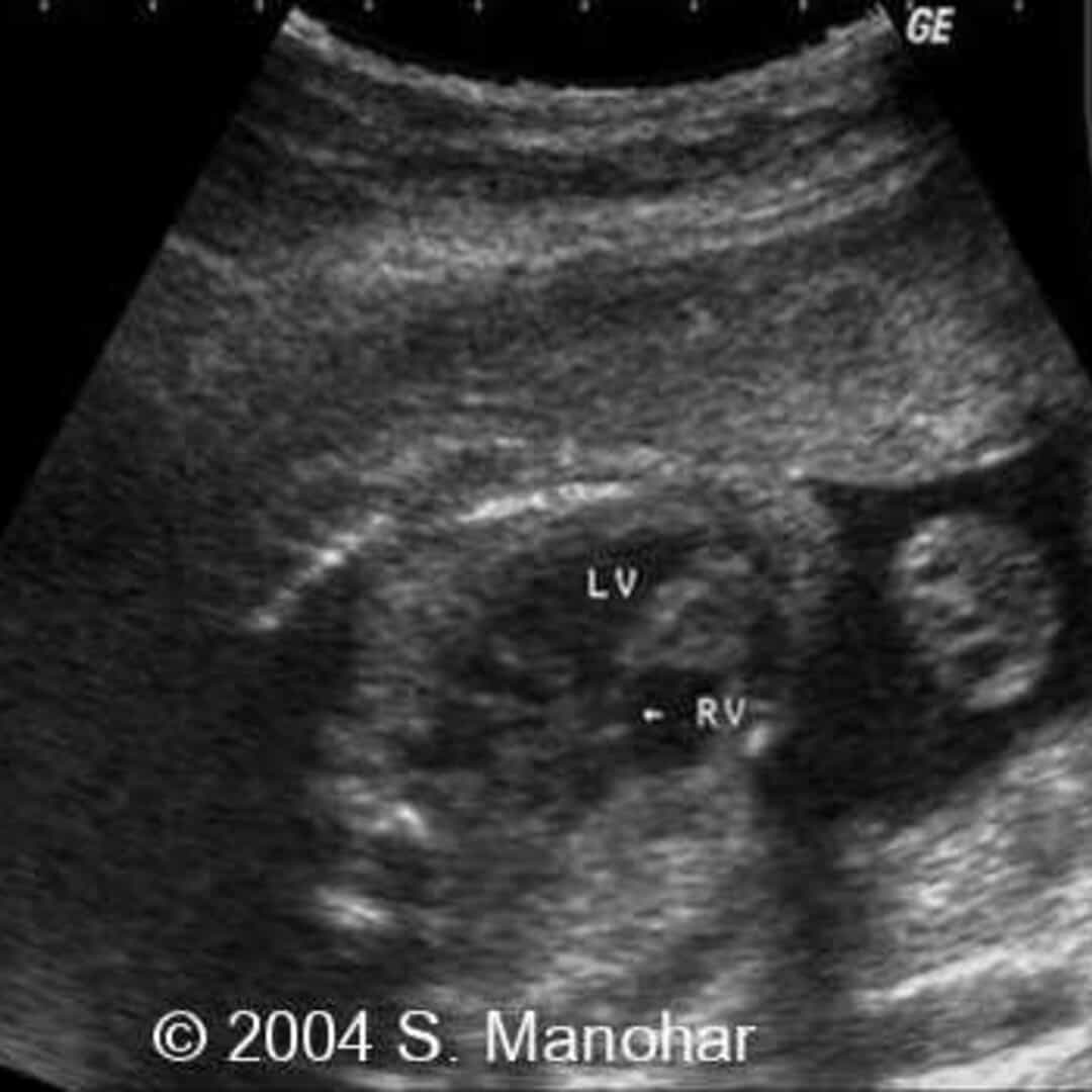 📃 Radial ray aplasia