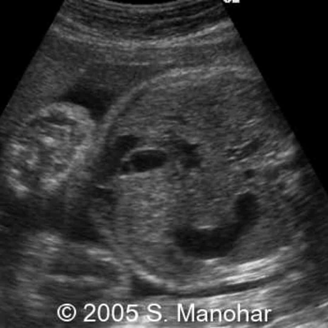 📃 Persistent right umbilical vein
