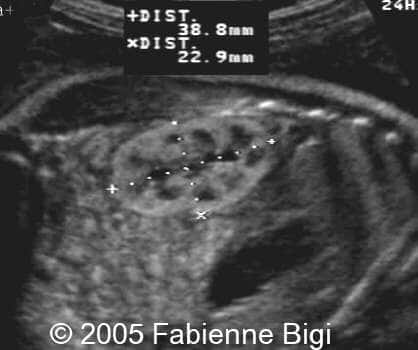 📃 Echogenic kidneys, bilateral