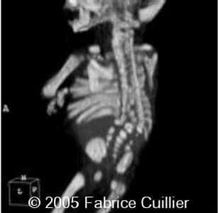 📃 Jarcho-Levin syndrome