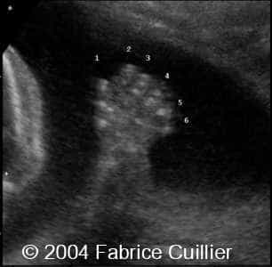 📃 Ellis-van Creveld syndrome
