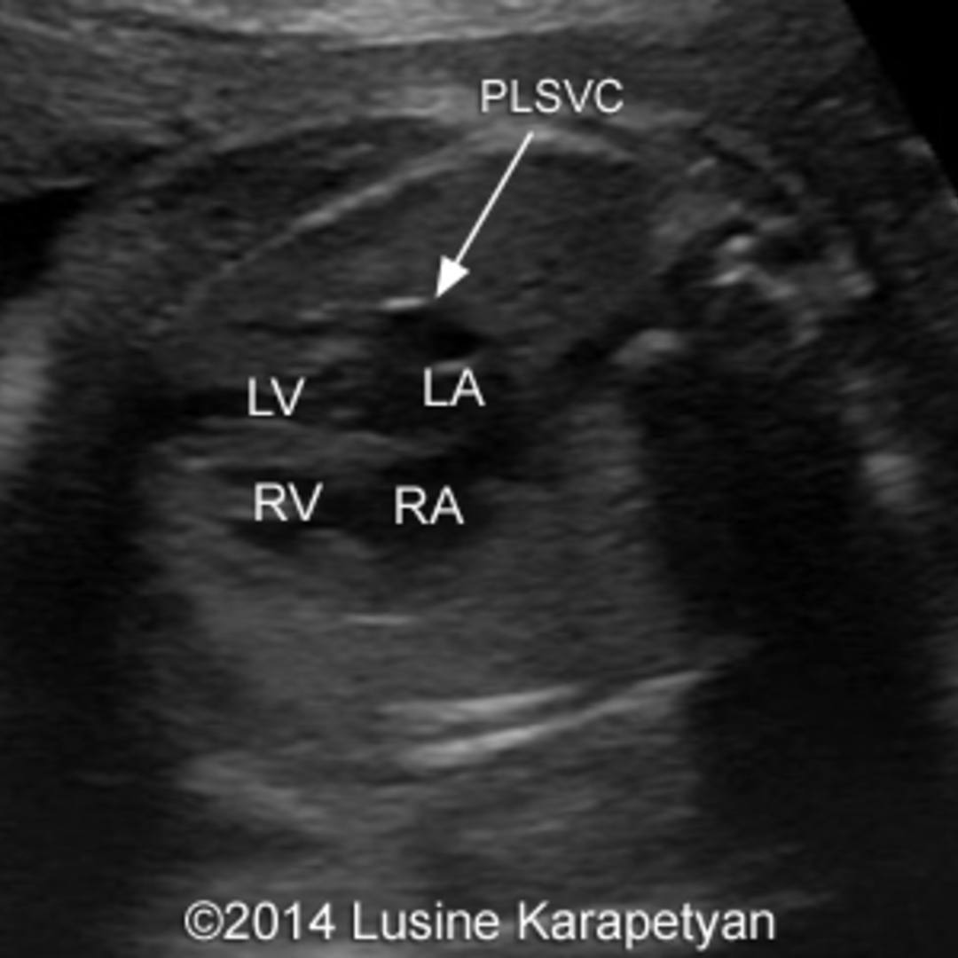 📃 Persistent left superior vena cava