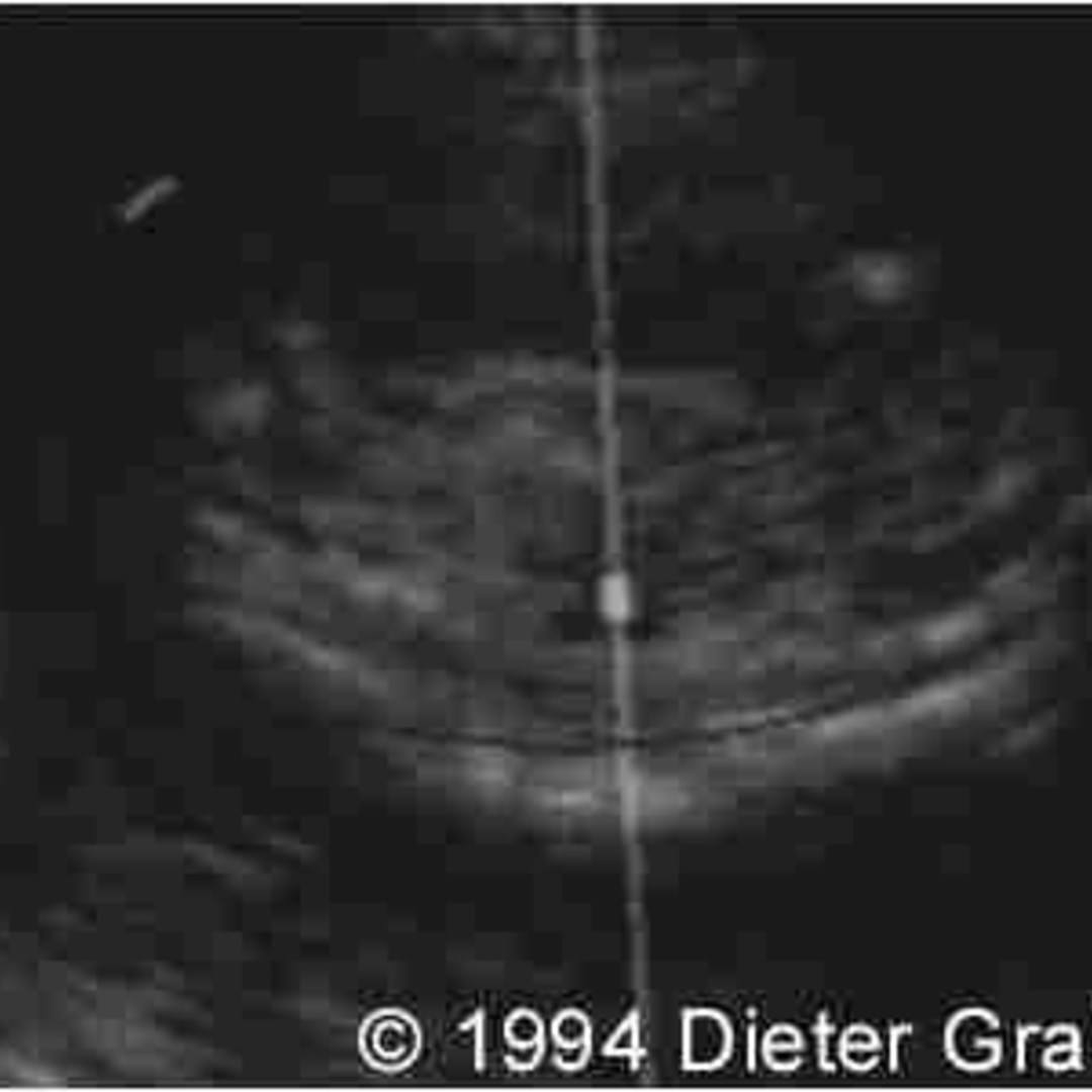 📃 TRAP, acardiac, outcome