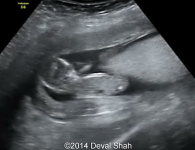 📃 Partial molar pregnancy