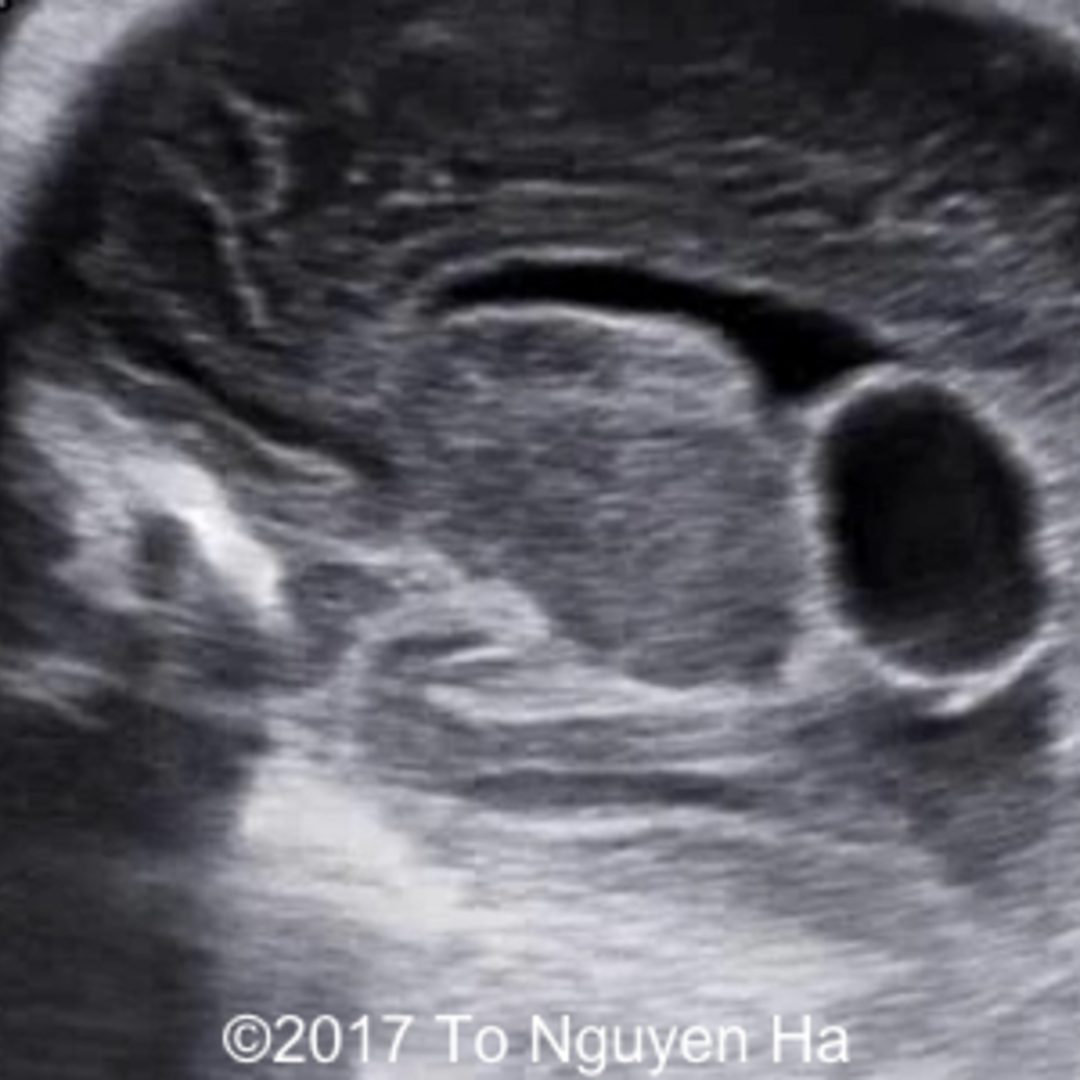 📃 Ventricular cyst