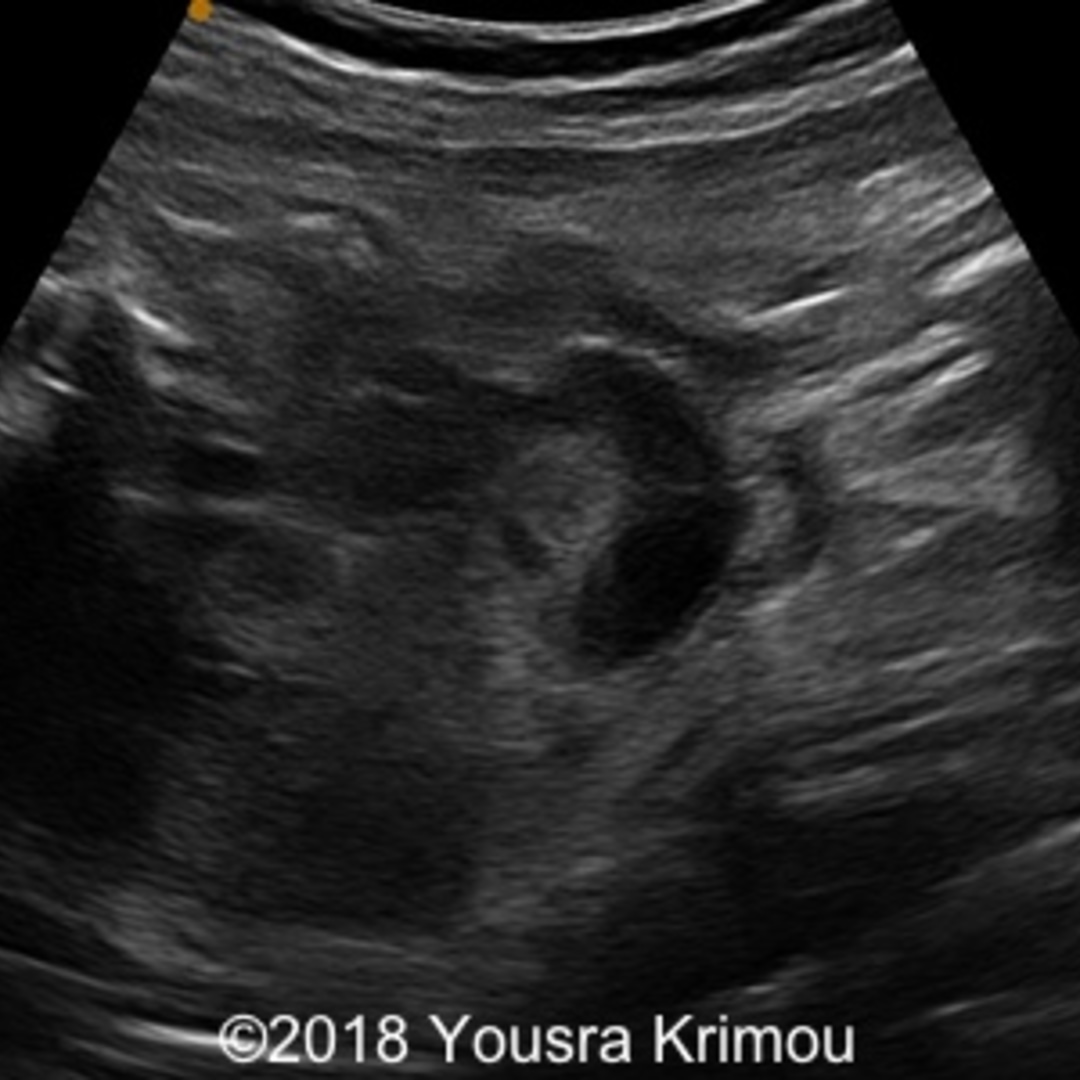 📃 Congenital megaureter