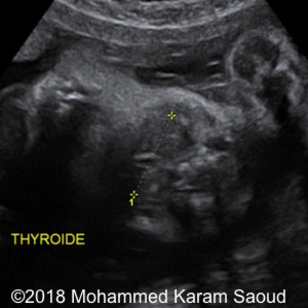 📃 Fetal Goiter