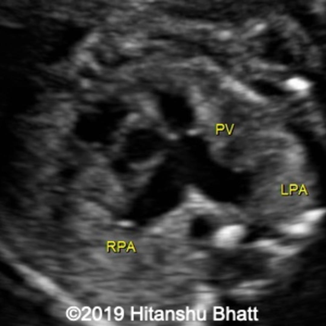 📃 Absent Pulmonary Valve Syndrome