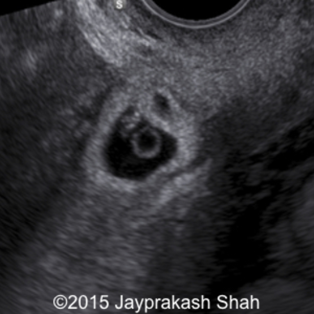 📃 LSCS scar ectopic pregnancy - Novel management experience
