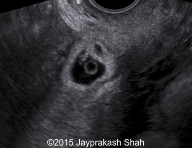 📃 LSCS scar ectopic pregnancy - Novel management experience
