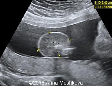 📃 Twin reversed arterial perfusion syndrome