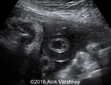 📃 True knot of the umbilical cord knot