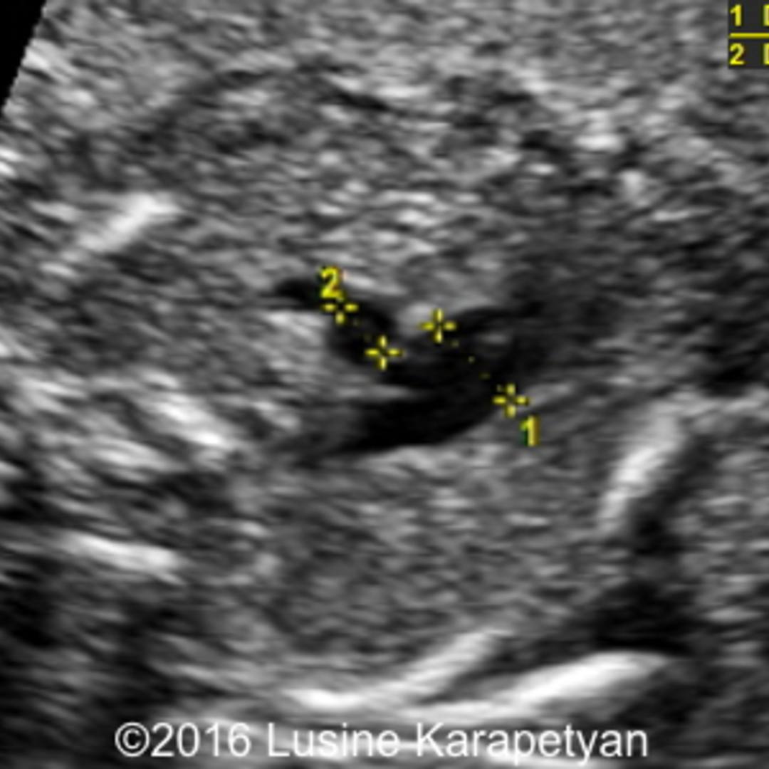 📃 Coarctation of the aorta, juxtaductal