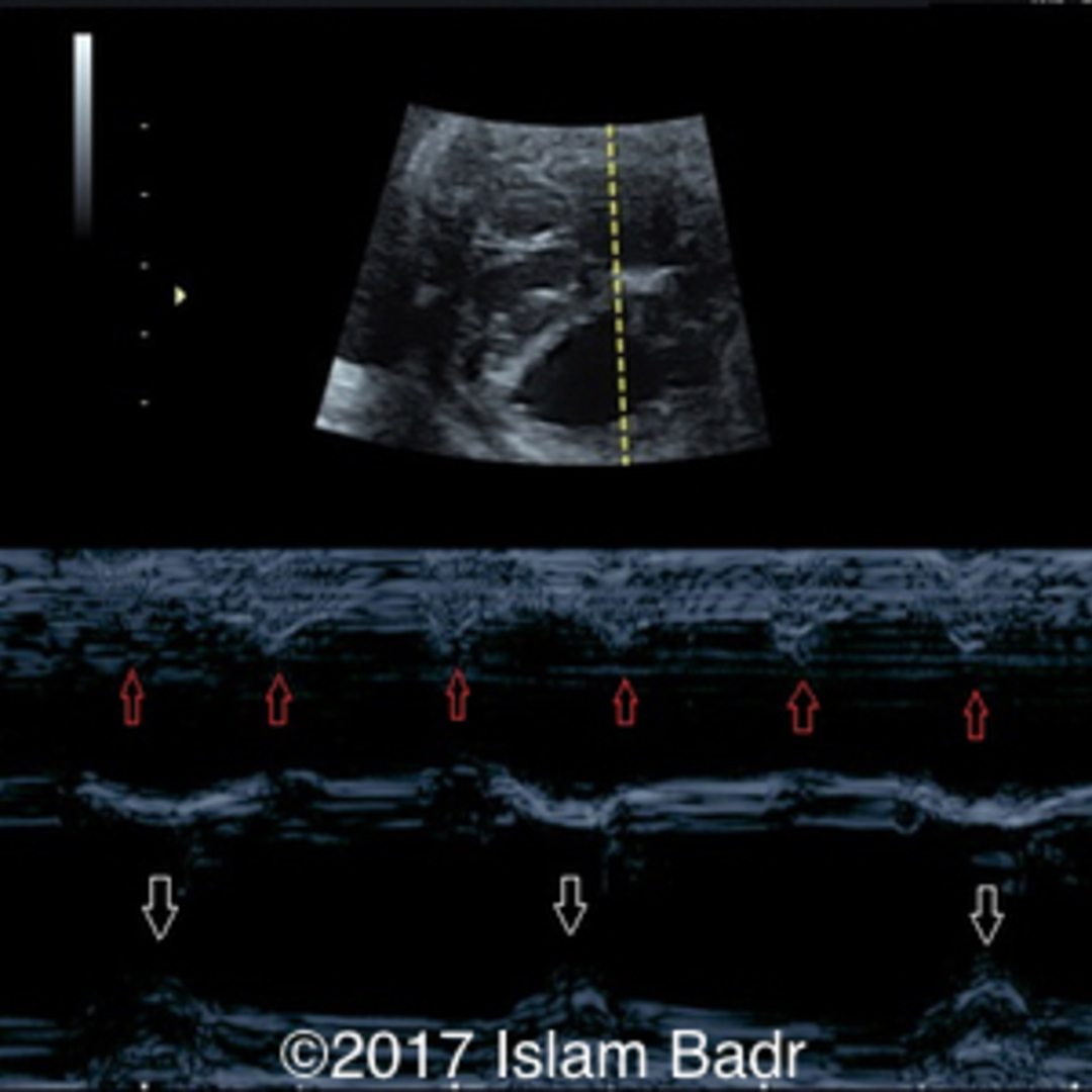 📃 Complete heart block