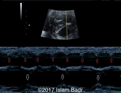 📃 Complete heart block