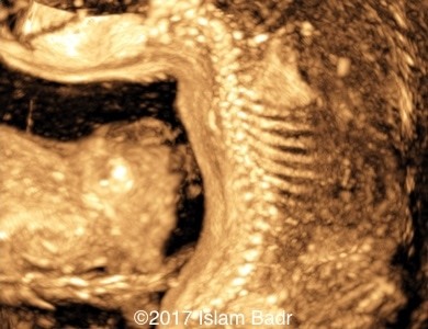 📃 Iniencephalus clausus