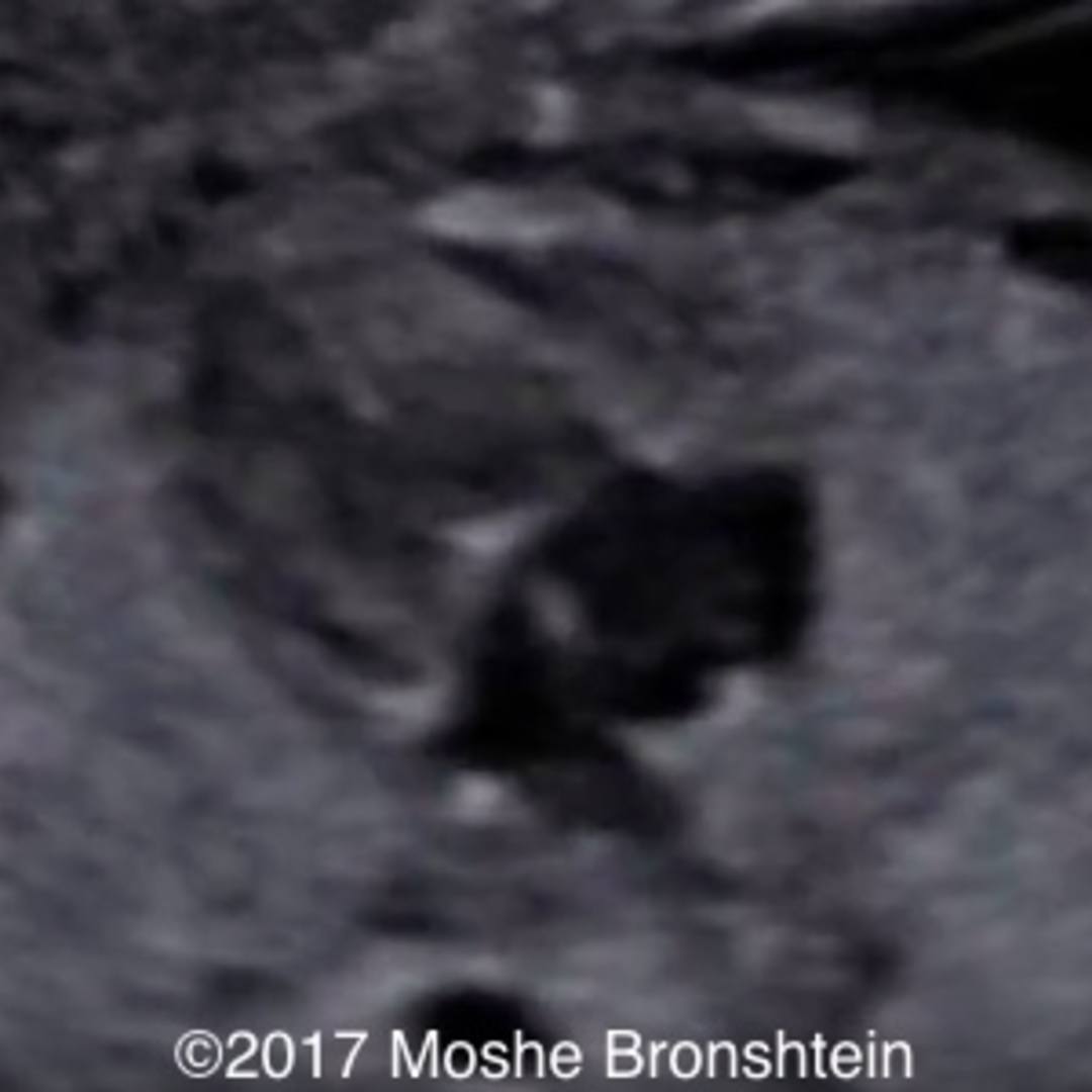 📃 Atrial septal defect (osmium primum)
