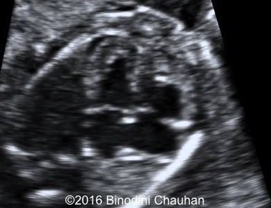 📃 Absent pulmonary valve syndrome