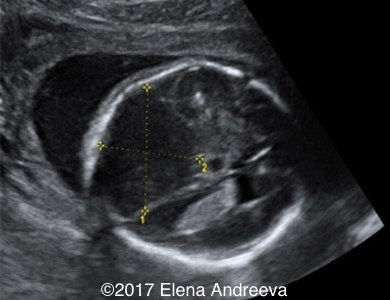 📃 Dural sinus thrombosis
