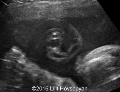 📃 True knot of the umbilical cord