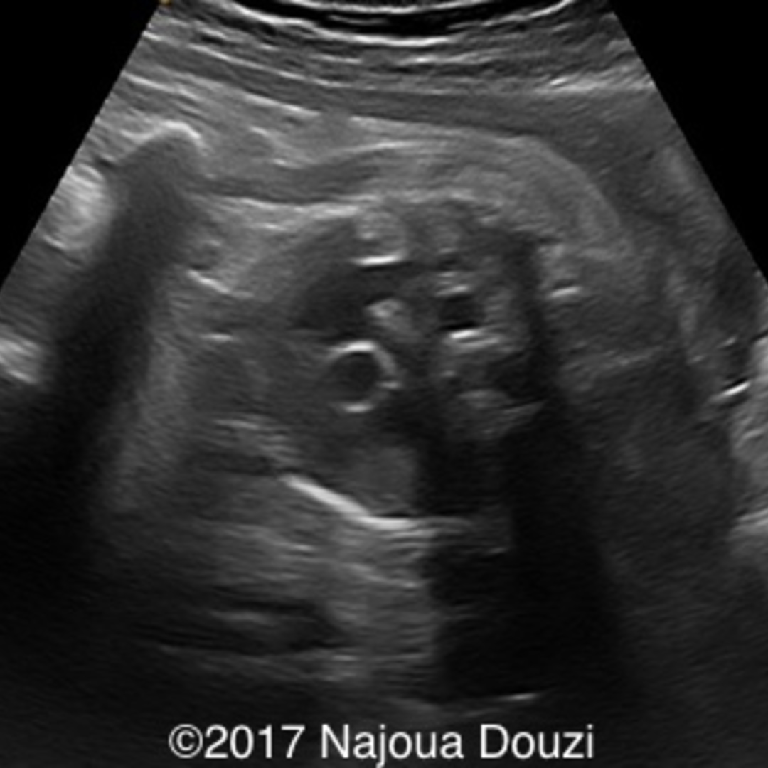 📃 Bilateral multicystic dysplastic kidneys (MCDK)