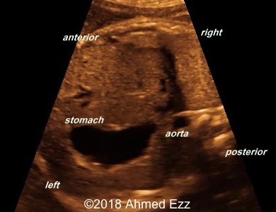 📃 Atrioventricular discordance with double outlet right ventricle