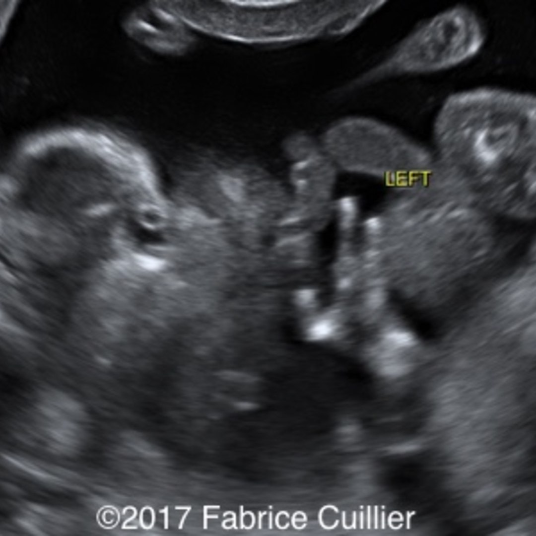 📃 Split hand syndrome