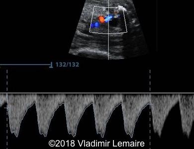 📃 Single umbilical artery