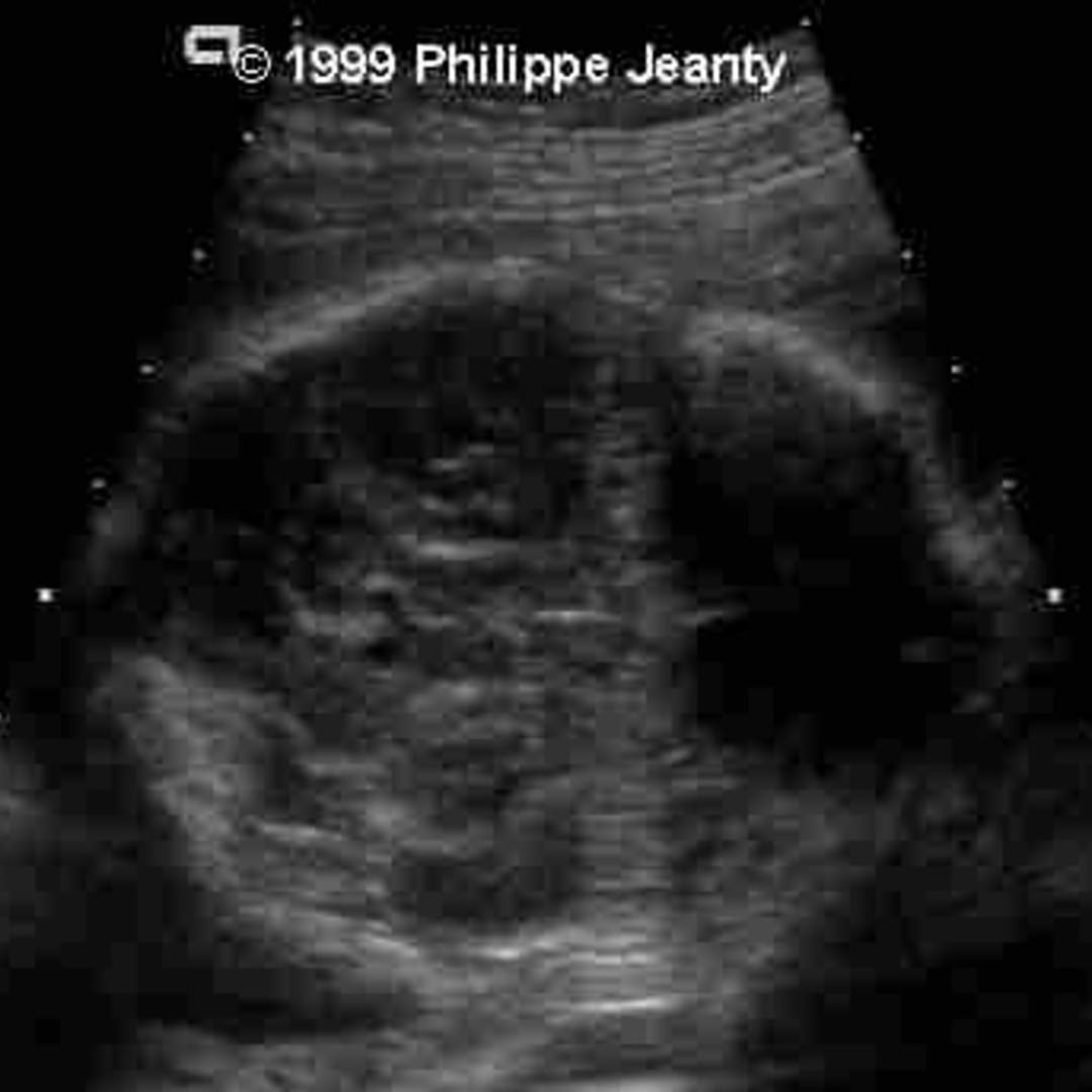 📃 Joubert syndrome