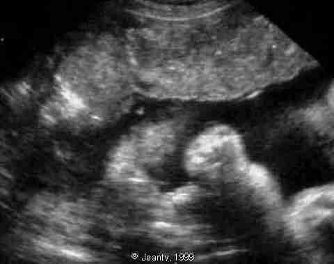 📃 Amniotic band syndrome