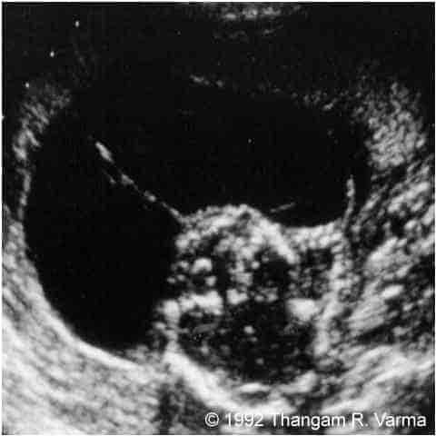 📃 Cystic hygroma, colli