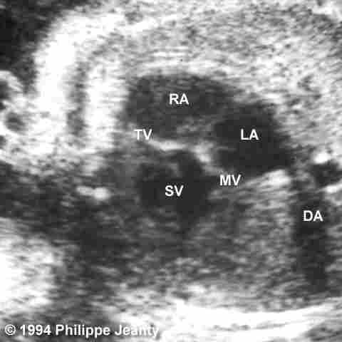 📃 Double inlet single ventricle