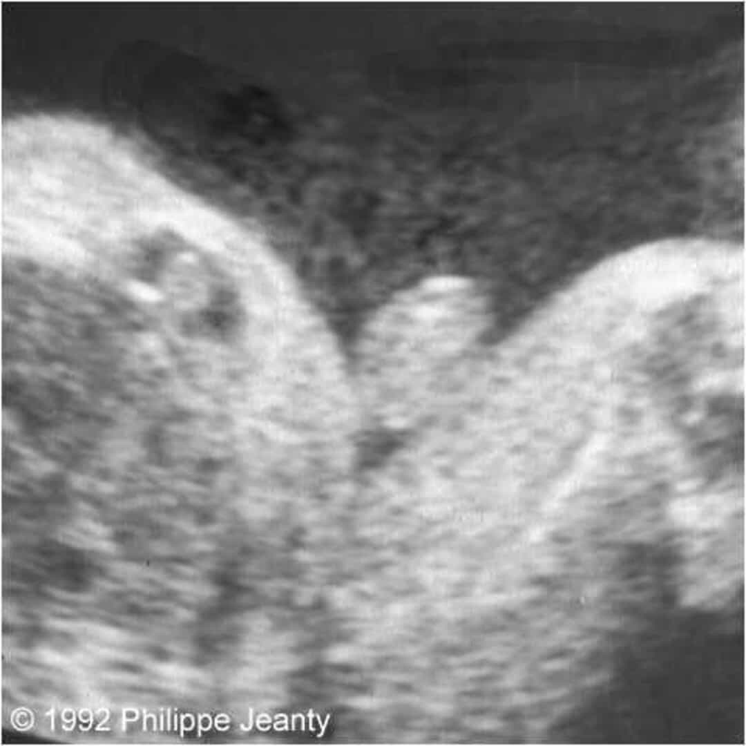  Cryptorchidism