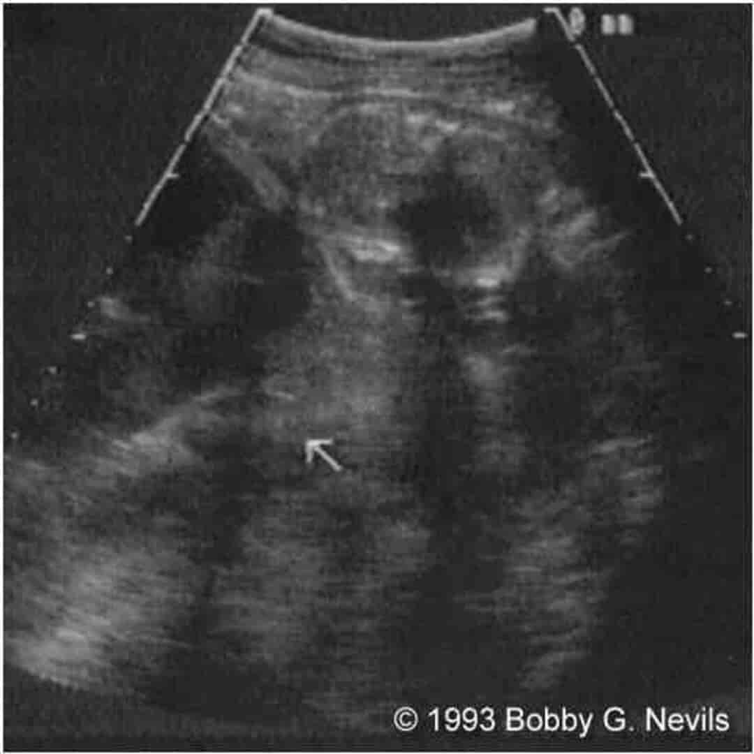 📃 Twin, acardiac, anceps