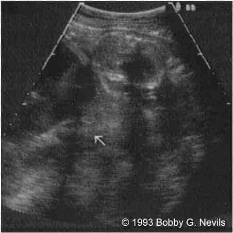 📃 Twin, acardiac, anceps