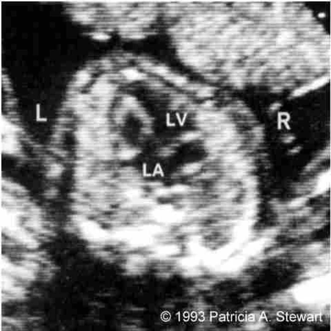 📃 Ventricles, inverted with transposition of the great arteries