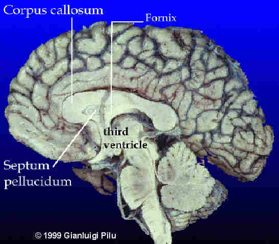 📃 Agenesis of the corpus callosum