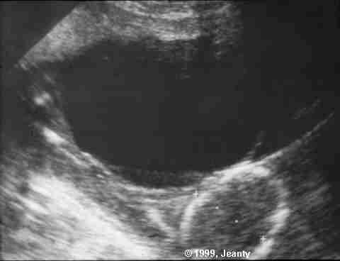 📃 Prune-belly syndrome