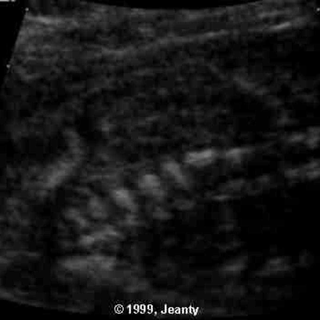 📃 VACTERL association