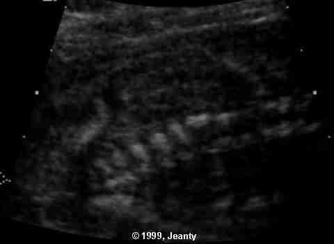 📃 VACTERL association