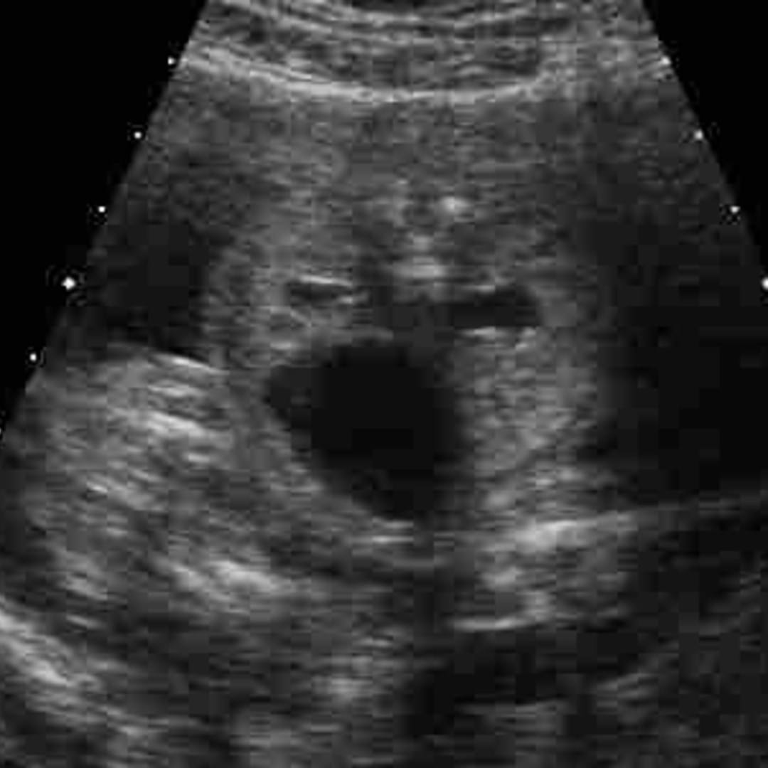 📃 Intestinal hypoperistalsis, megacystis-microcolon