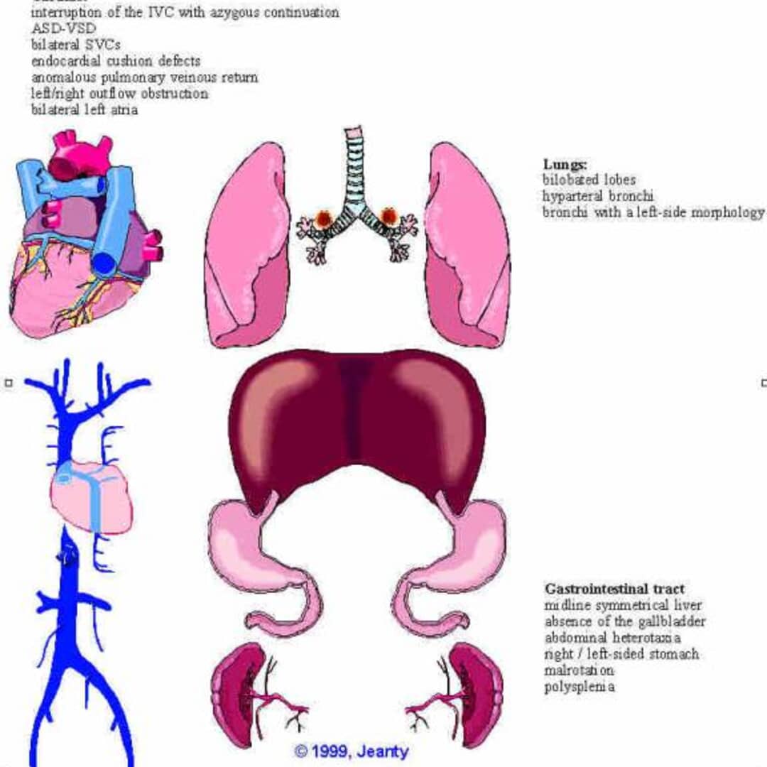 📃 Asplenia-polysplenia syndromes