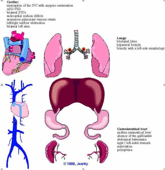 📃 Asplenia-polysplenia syndromes