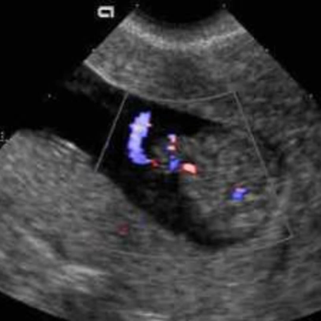 📃 Beckwith-Wiedemann syndrome