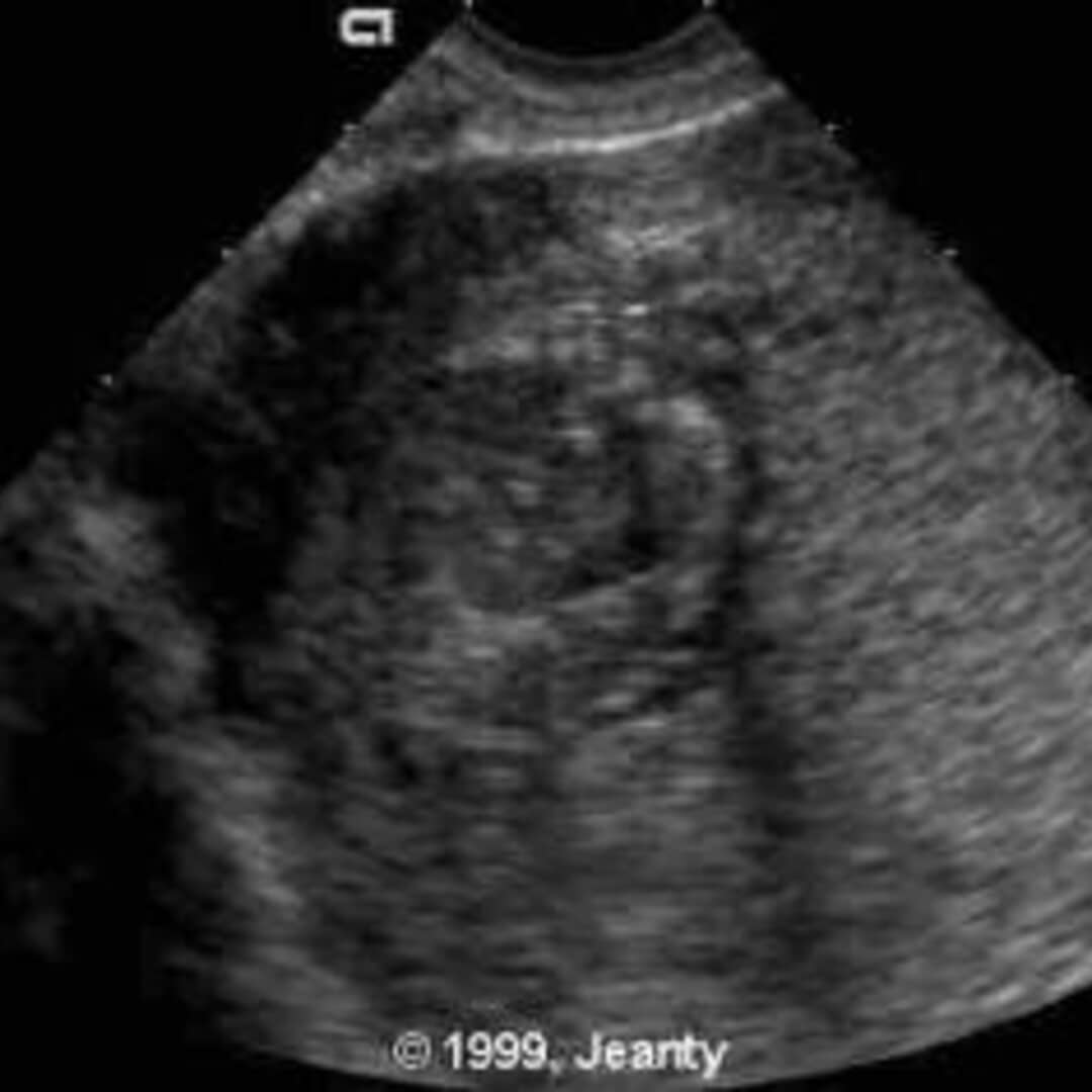 Renal Agenesis Ultrasound Bilateral Renal Agenesis