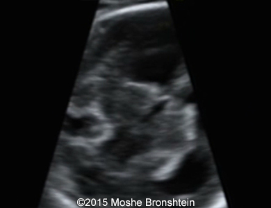 📃 Trisomy 13
