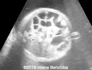 📃 Colonic atresia